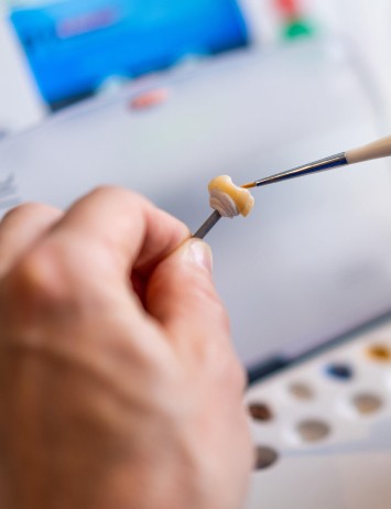 Les Inlays - Onlays | Chirurgien-dentiste à Nancy (54000) | Dr Mortier