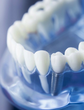 L’implantologie | Dr Christophe Mortier | Chirurgien-dentiste à Nancy